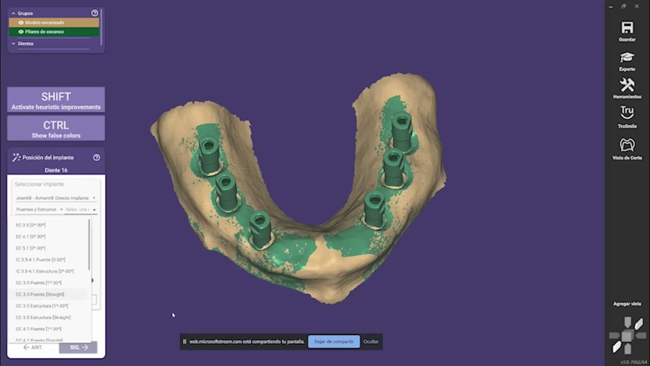 Tutorial sobre las Librerías Digitales de Exocad - YouTube