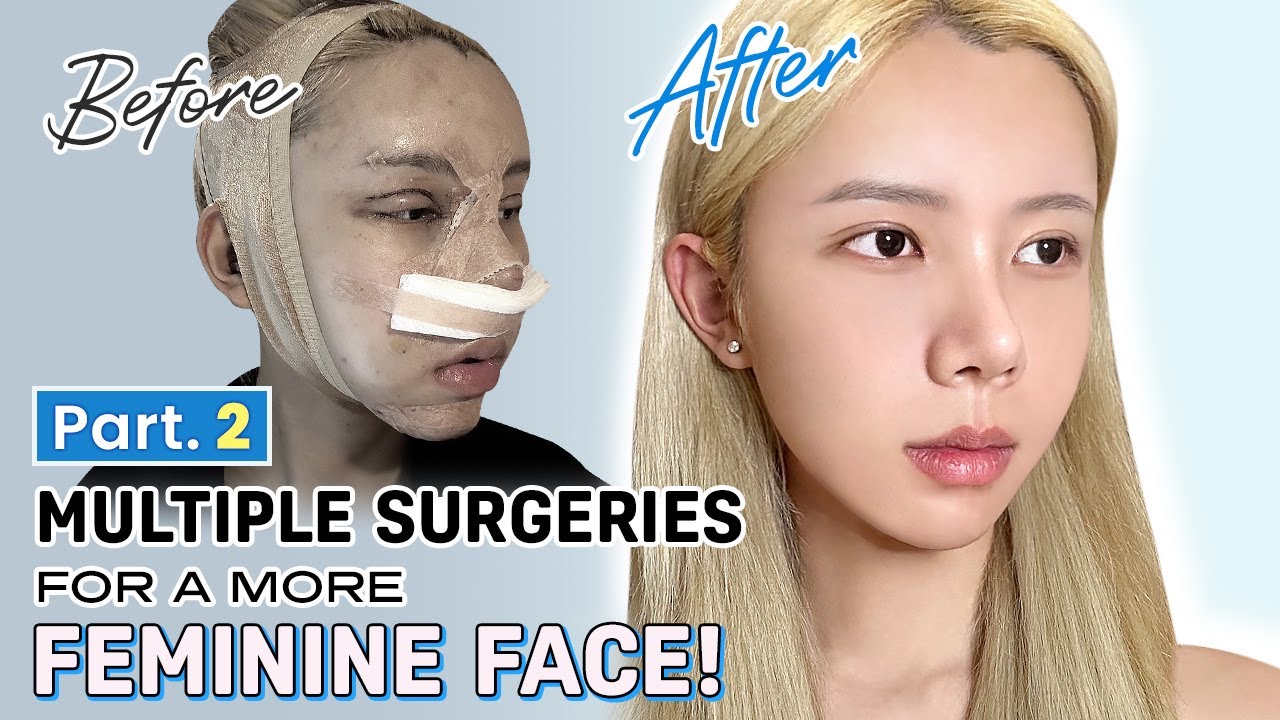 [SUB]Part 2-UPDATE on Full face transformation safely done in ONE DAY ...
