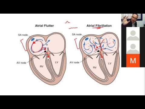 ECG 3a : Rhythm disturbances 3 - YouTube