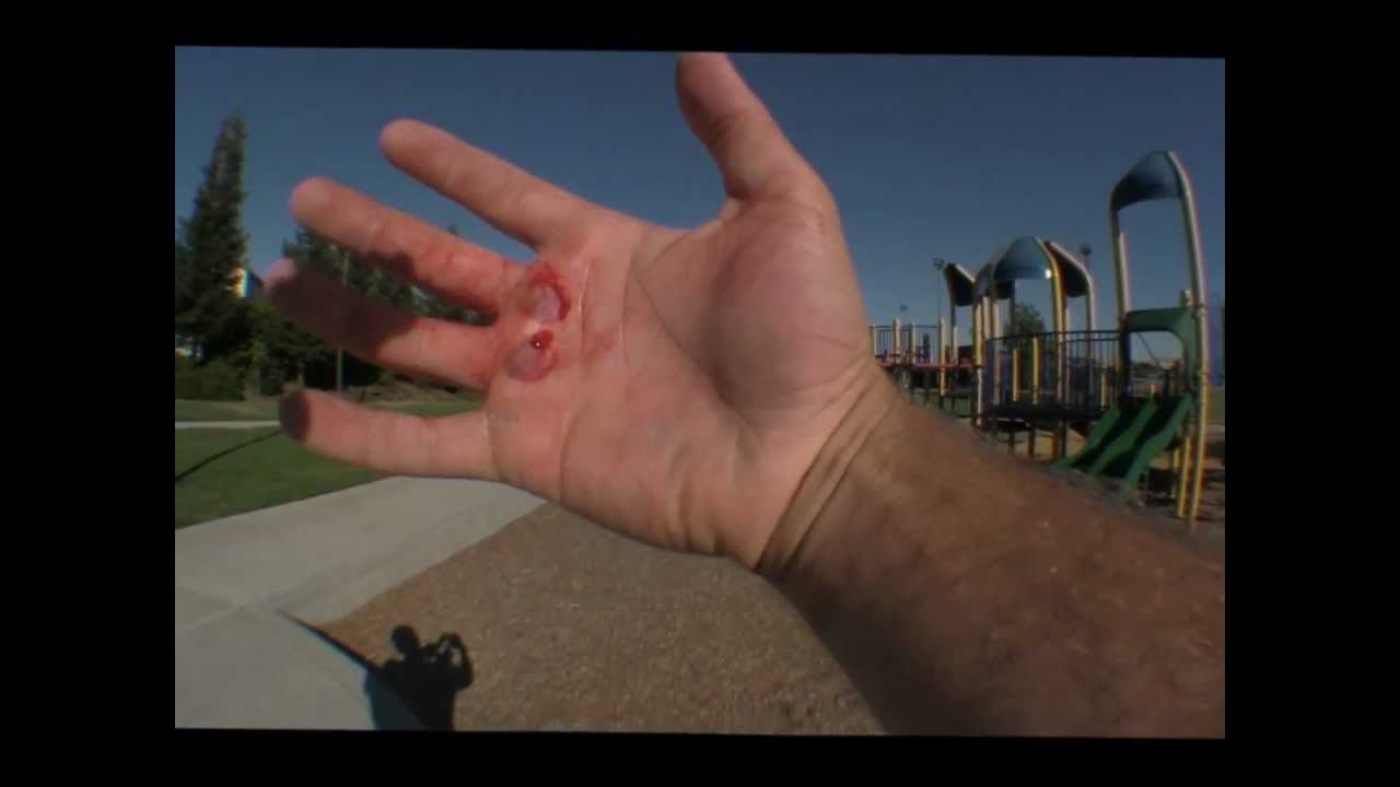 Parkour: Bloody Hand Fail Swining on Bars - YouTube