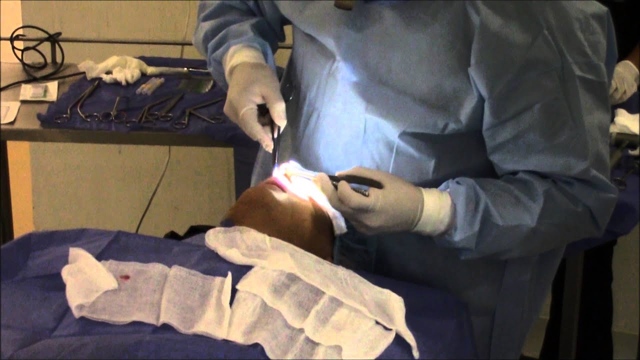 DIA 3 E (sutura transfictiva HD) - YouTube