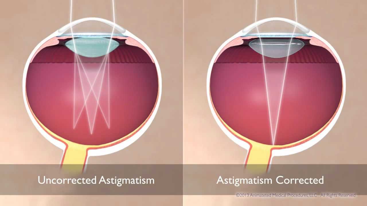 How do Active Life Lenses work? - YouTube