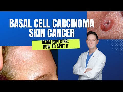 How To Remove Basil Cells From Skin