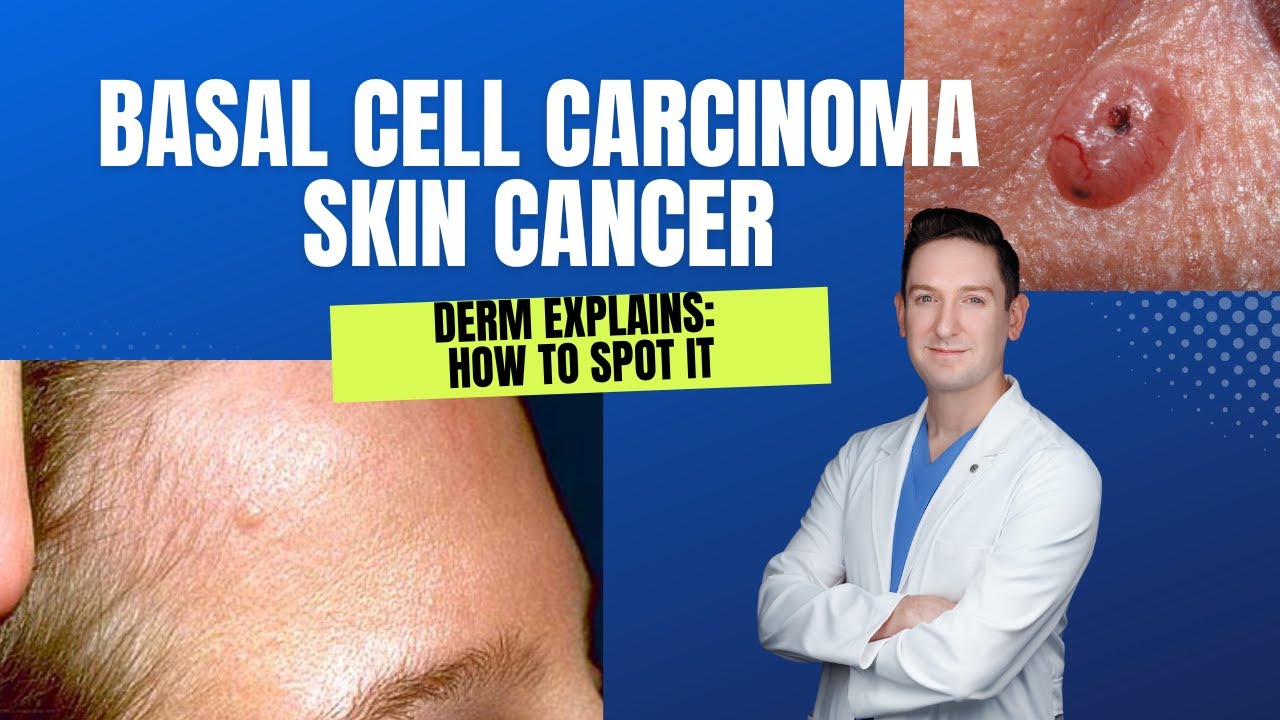 Basal Cell Carcinoma: Everything you need to know about the most common ...
