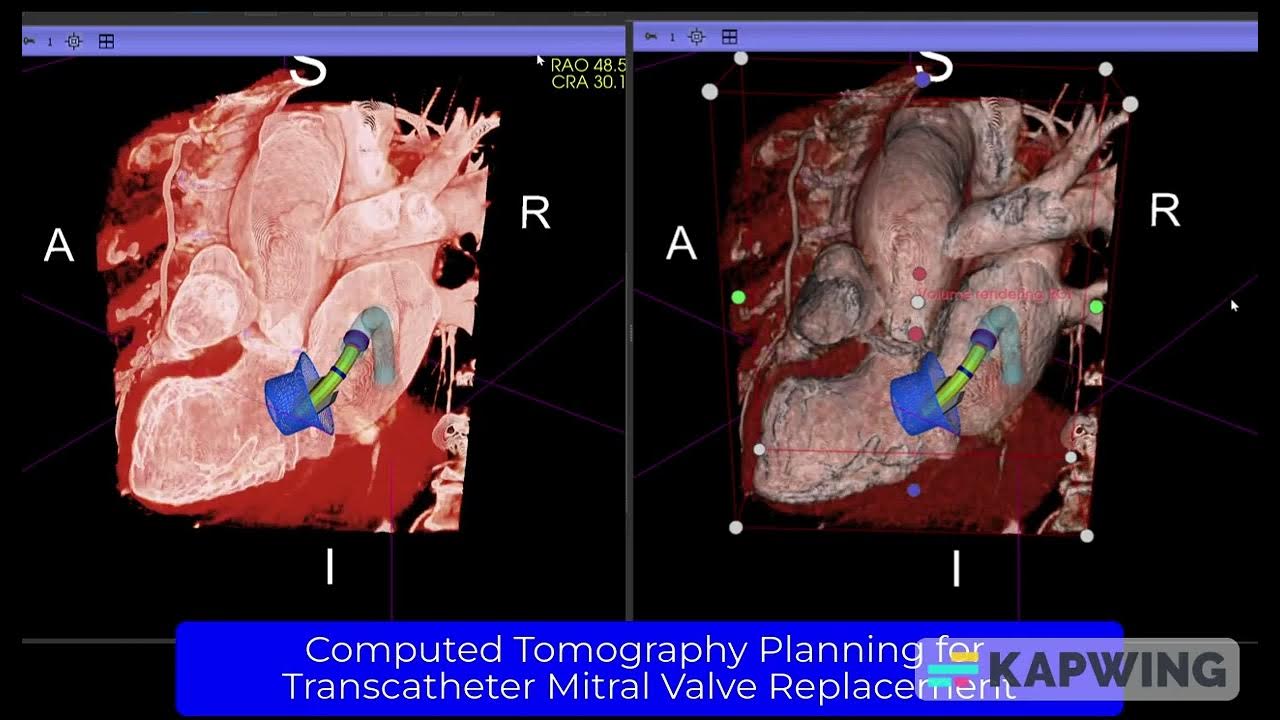 Cardiac Tomography planning for transcatheter mitral valve replacement .made in Perú - YouTube