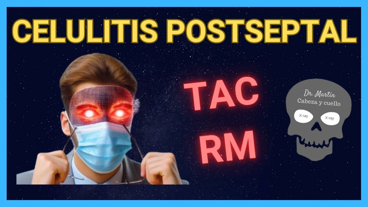 CELULITIS POSTSEPTAL: Signos Radiológicos 👀 - YouTube