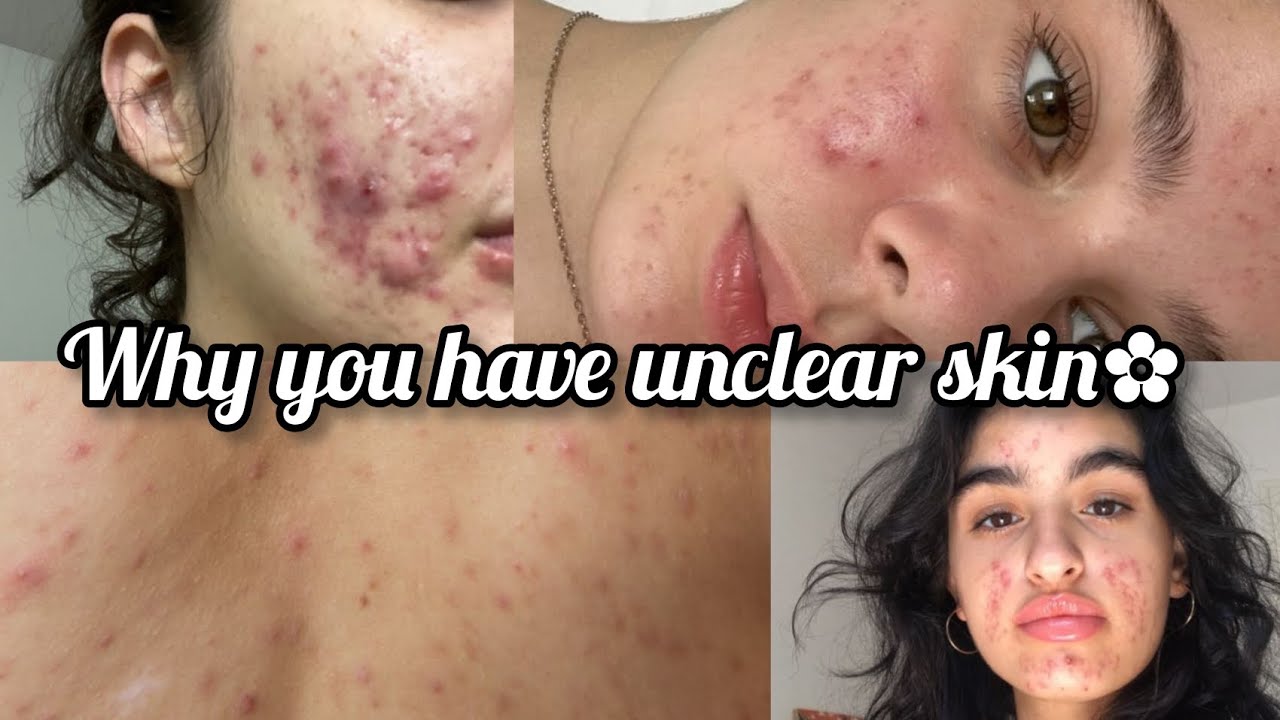 Reasons why you have unclear skin - YouTube