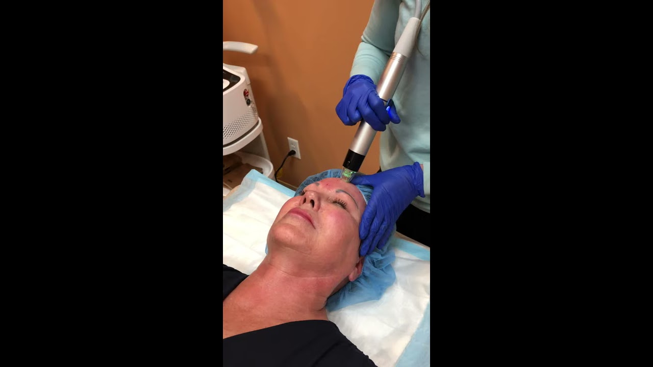 Genius RF Micro-Needling - YouTube