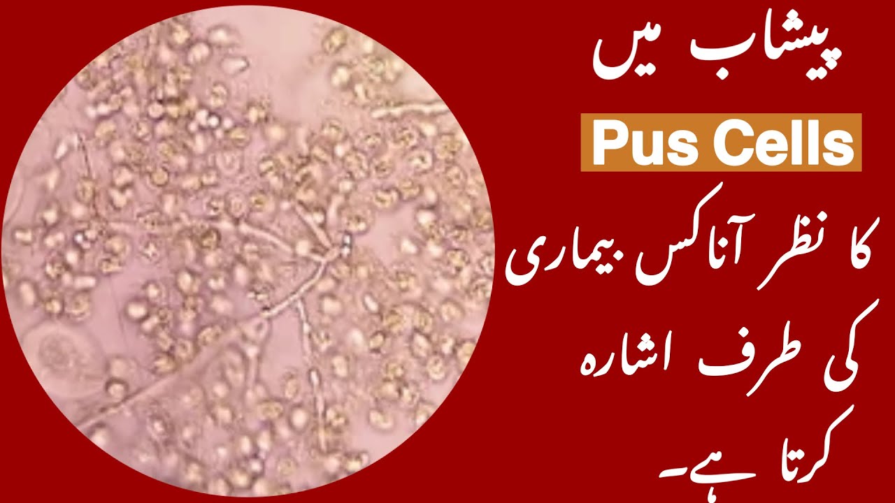 Pus Cells In Urine Urdu Hindi What Do Pus Cells In Urine Indicate pus-cells-in-urine-urdu-hindi-what-do-pus-cells-in-urine-indicate