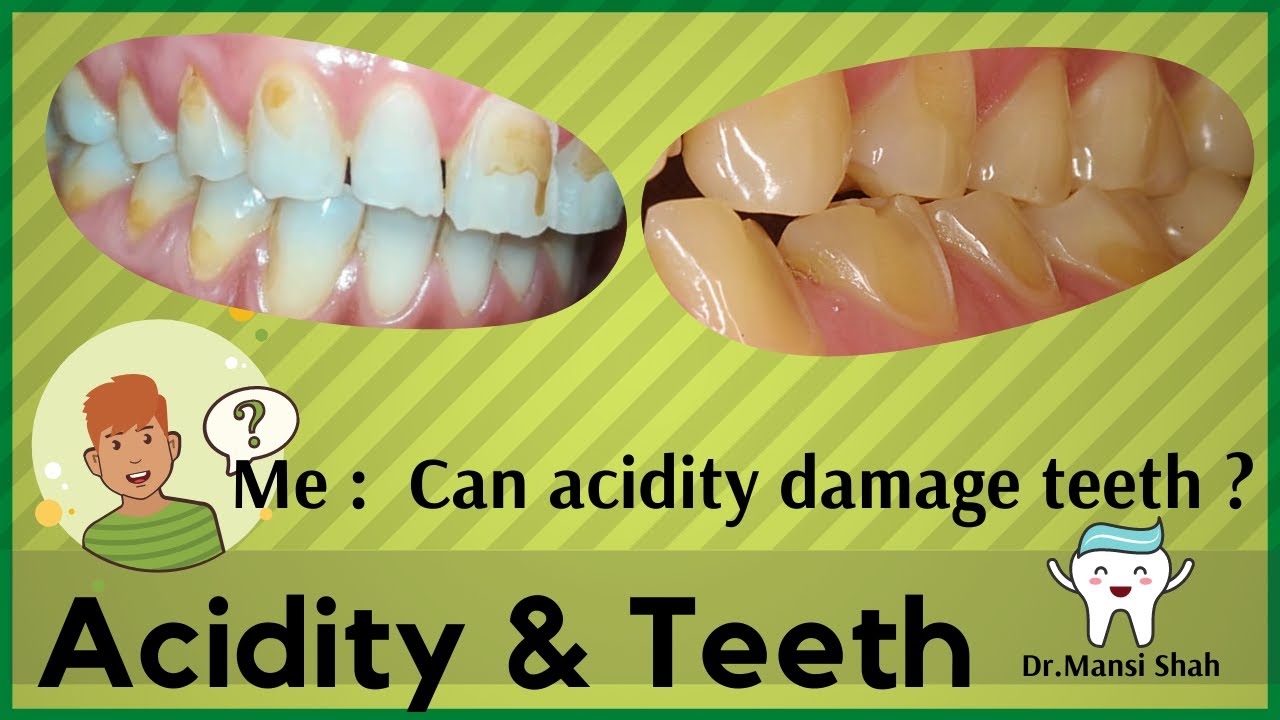 Acidity And Teeth Problem | Teeth Erosion and Sensitivity - YouTube