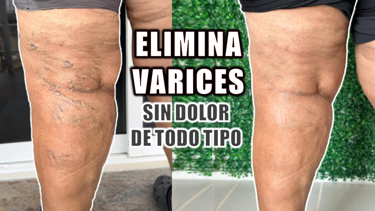 LO MEJOR PARA ELIMINAR VARICES SIN DOLOR DE TODO TIPO - Caso Ema - YouTube