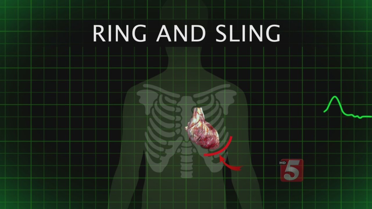 Ring & Sling To Treat AFib In The Heart - YouTube