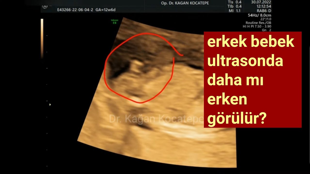 12 hafta 6 günlükken cinsiyetini gösteren bebek, erkek bebek cinsiyeti ...