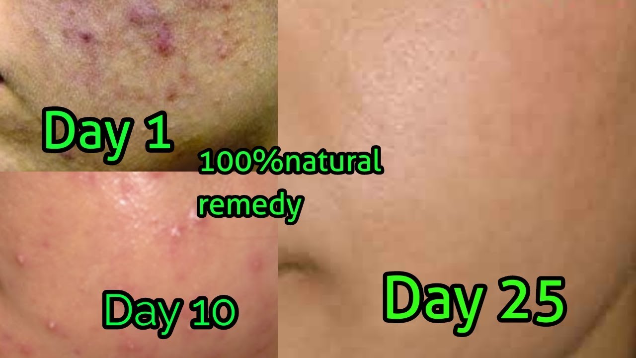How I repair my damaged skin naturally/close large open pores/The ...