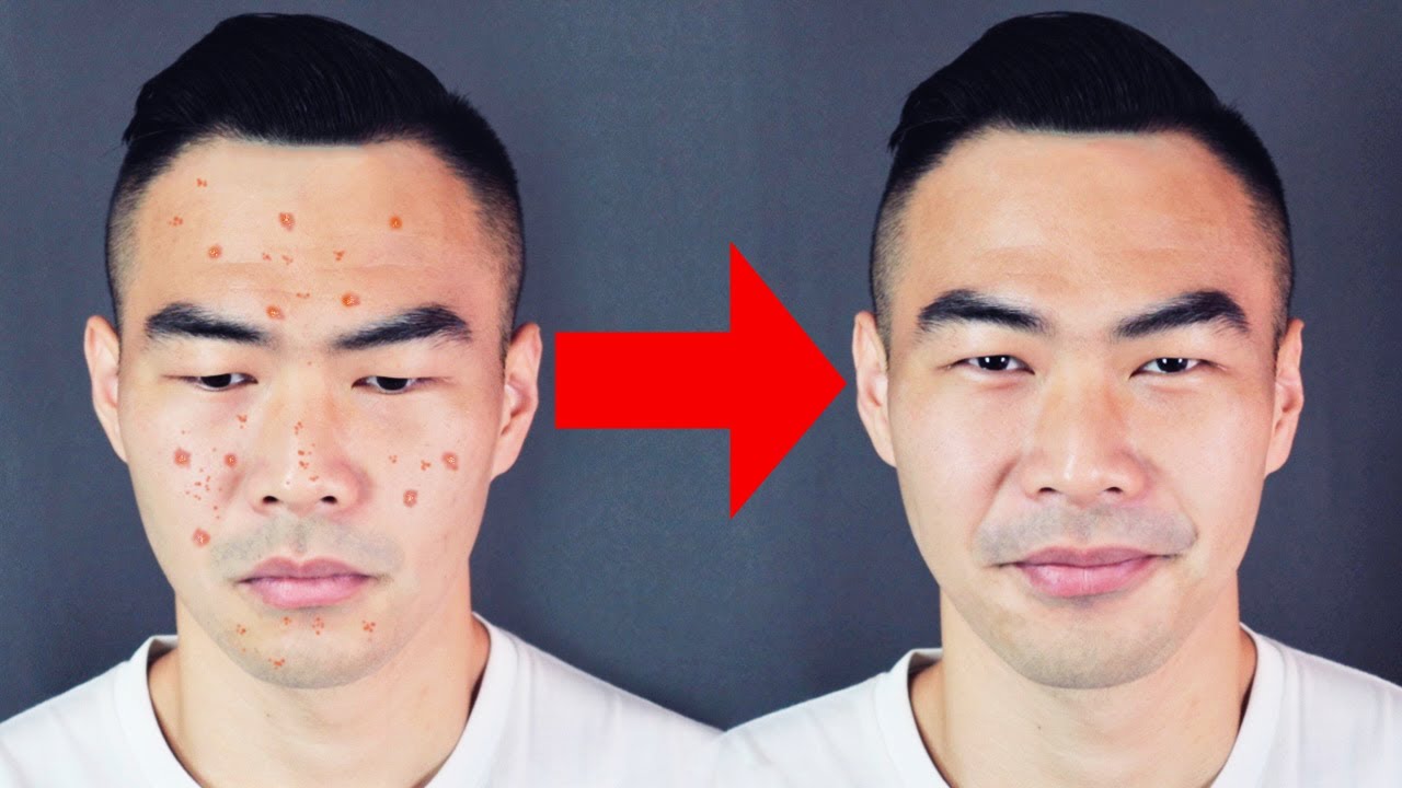7 FREE Ways to Have a Clear Skin | Fight Acne like a PRO - YouTube