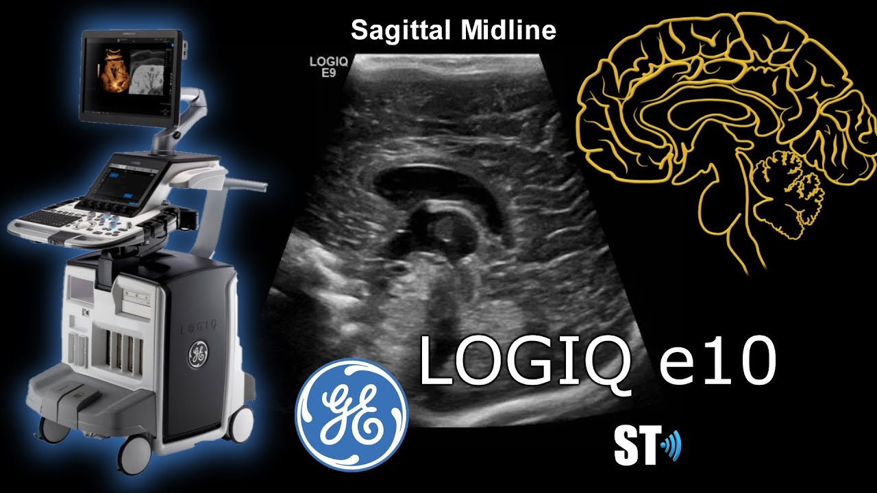 GE Logiq e10 Neurosonography demo and protocol - YouTube