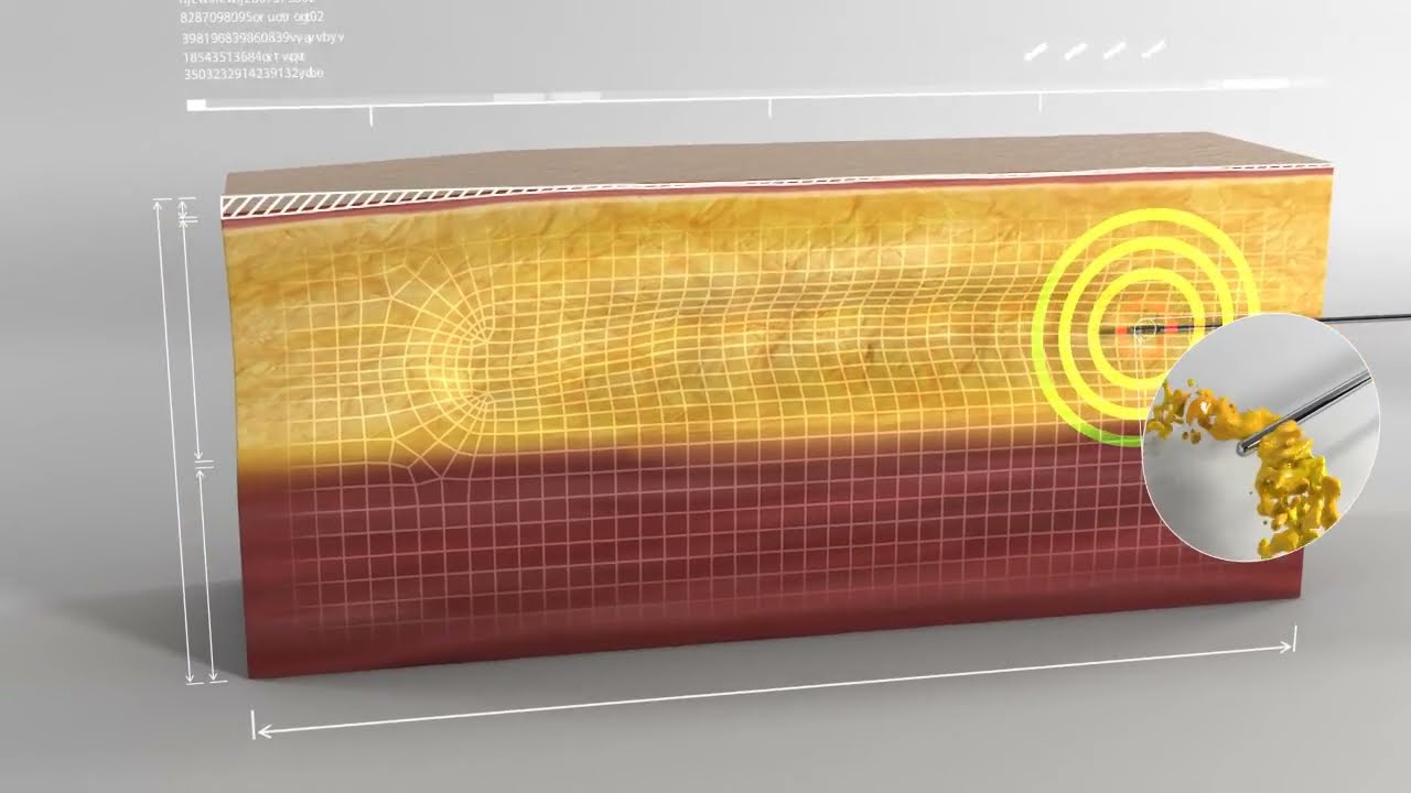 Lipotite introduction video (APOLEX) - YouTube