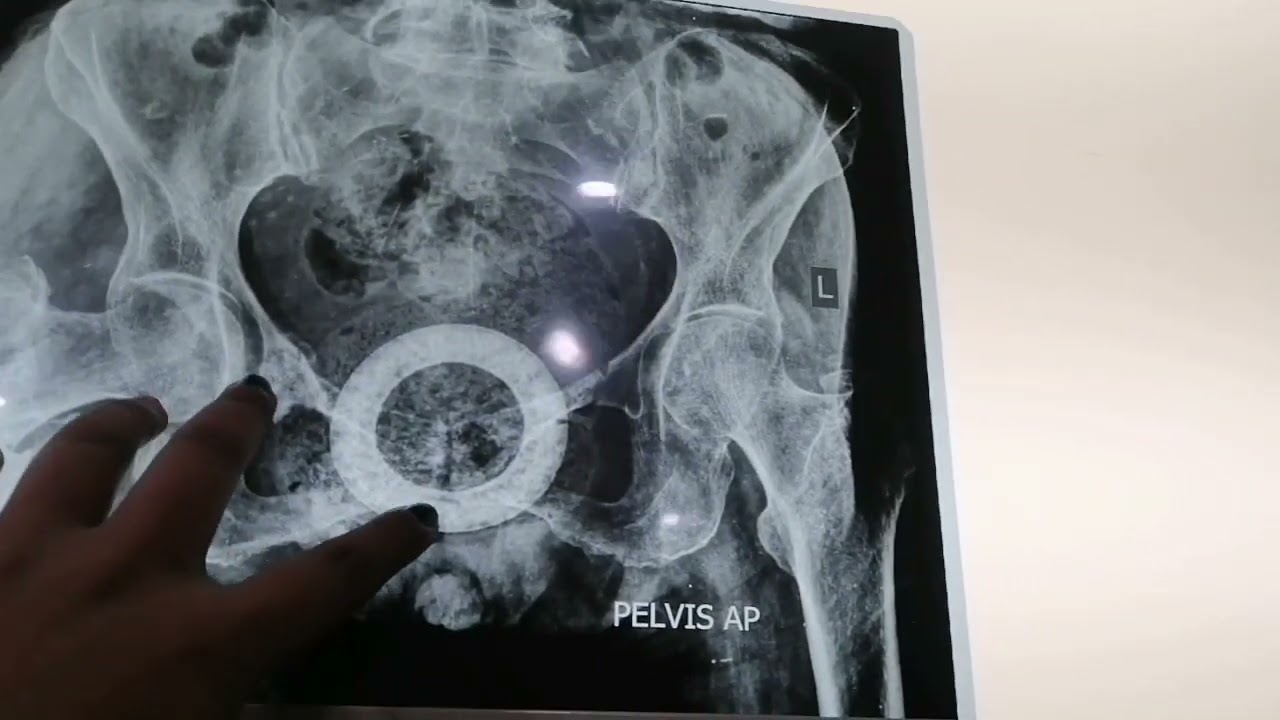 Xray Of Pelvis Vaginal Pessary Ring Xray Radiology Youtube