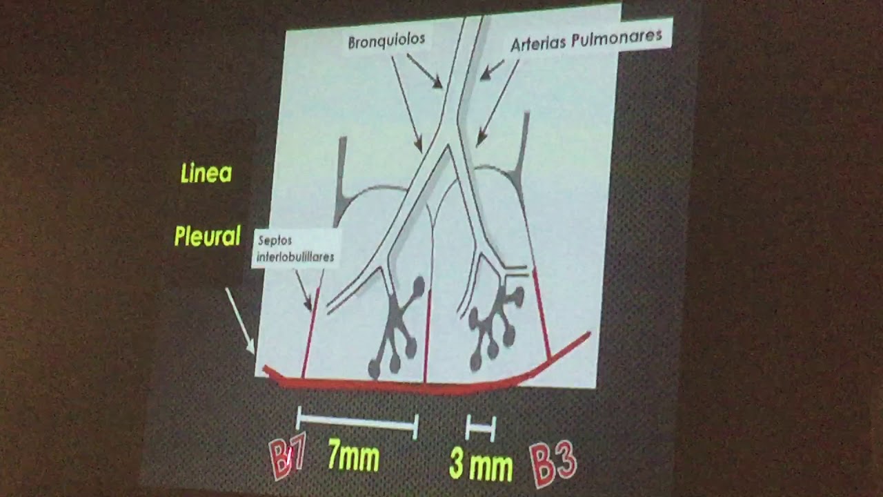 ECOGRAFIA PULMONAR (PATRON INTERSTICIAL PARTE 2) - YouTube