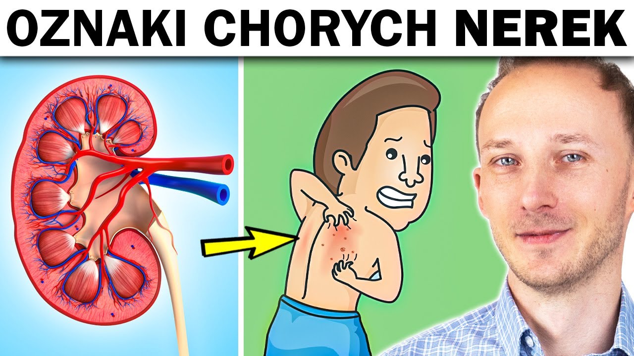 Nerki Objawy Worldwide Ship | www.micoope.com.gt