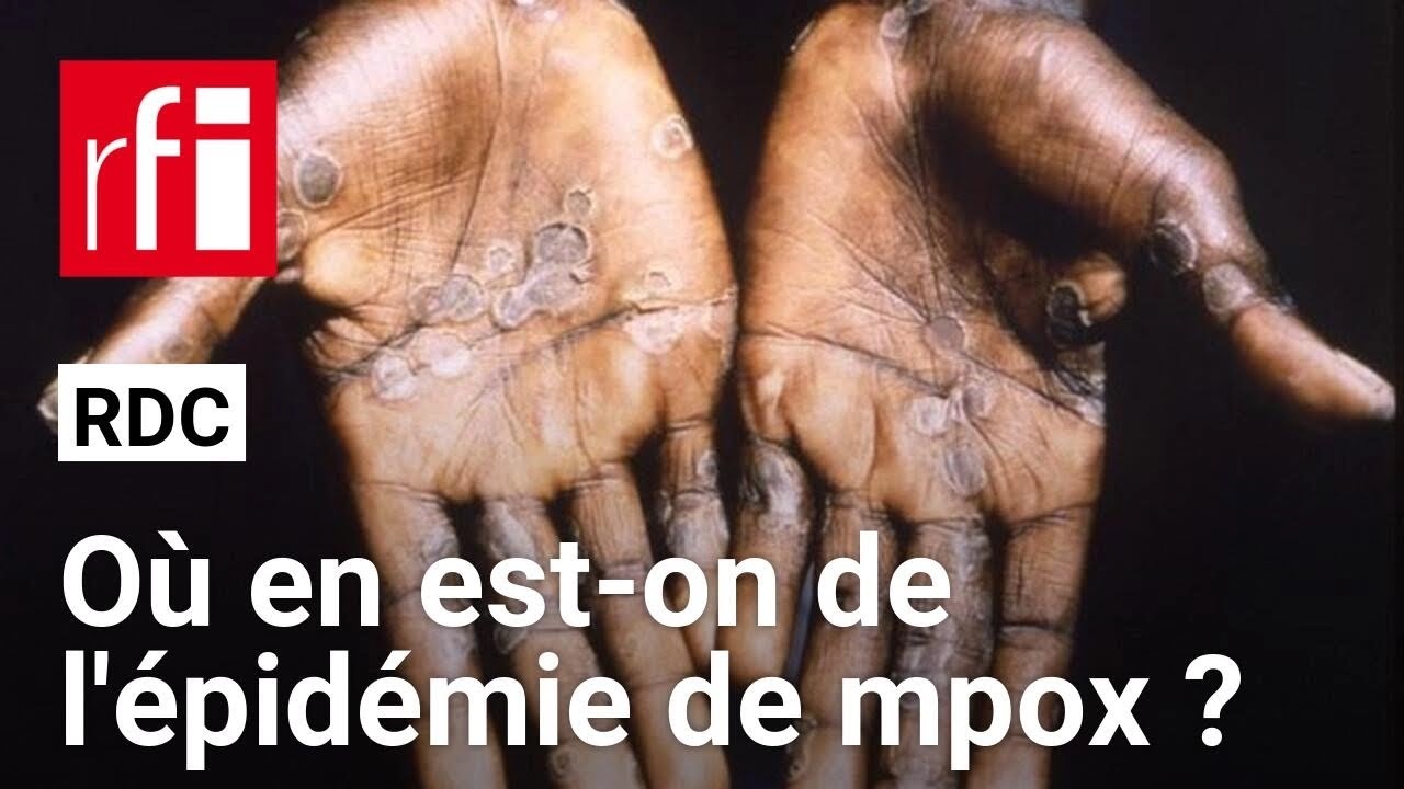 RDC : l'épidémie de mpox continue à progresser dans la région de Goma à ...