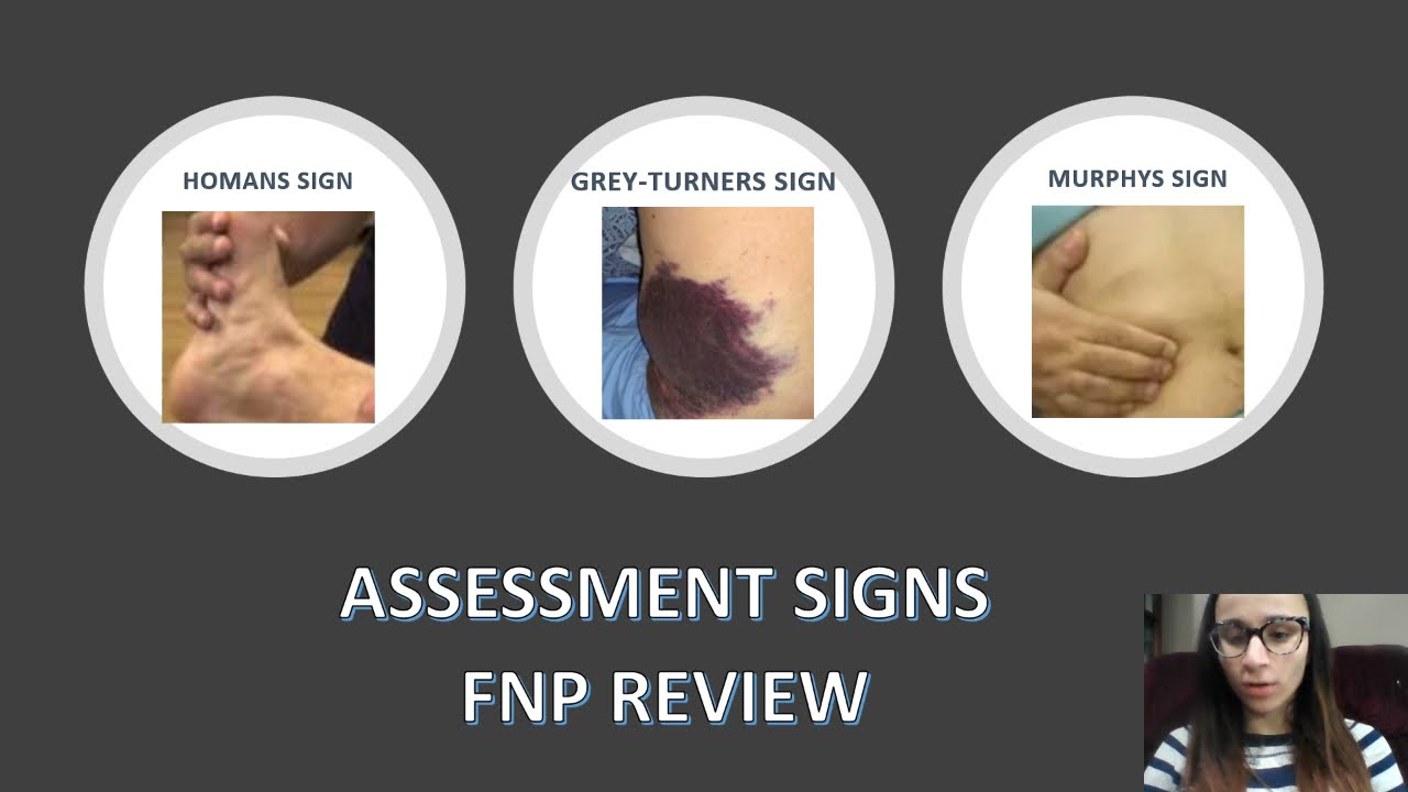 NP Board Review- McBurney, Cullen's, Psoas, Lachman, Homans, Obturators ...