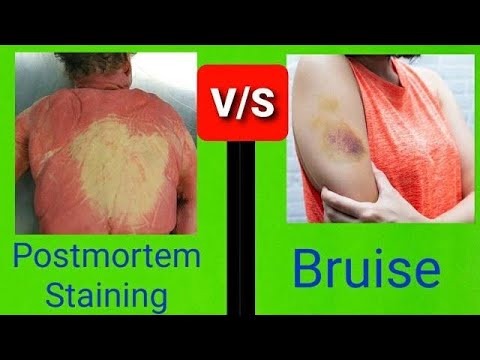Bruise v/s Hypostasis|bruises|bruise forensic medicine|contusion ...