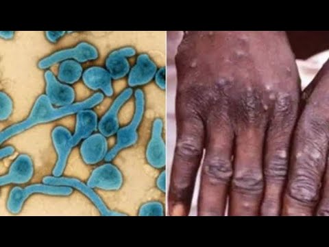 Marburg Virus Disease : Everything To Know - YouTube