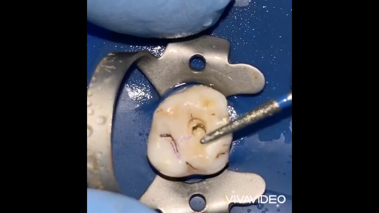 MB2 Maxillary Molar Part 4 (with subtitles) - YouTube