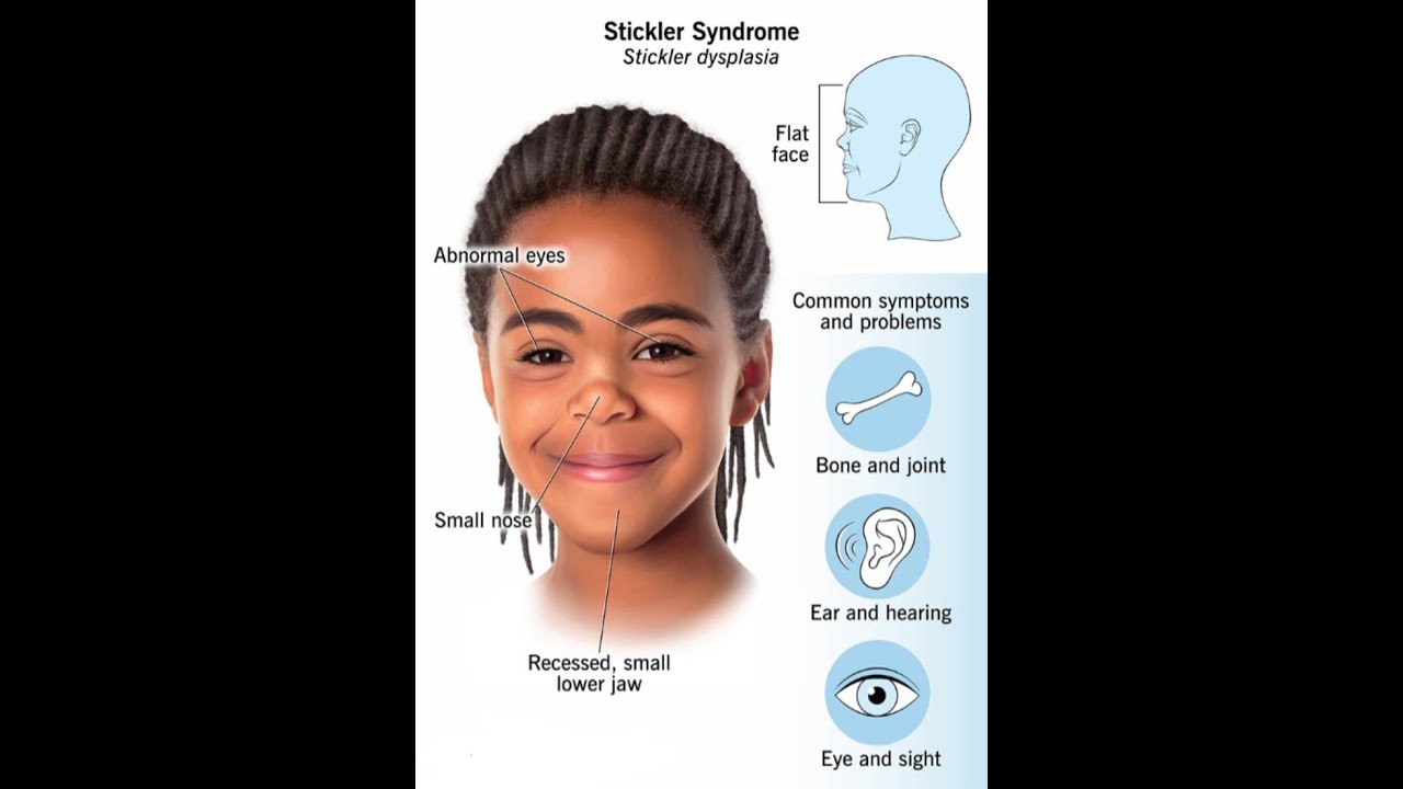 Stickler Syndrome Or Stickler Dysplasia ; Definition, Causes ...