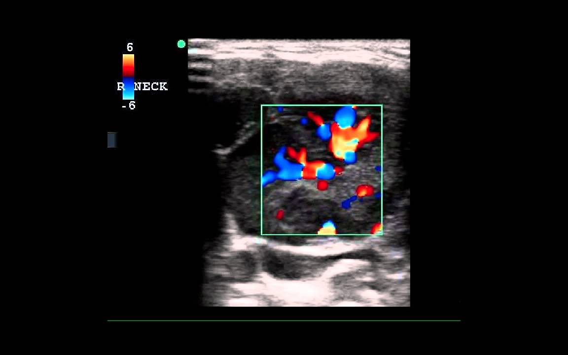 Neck swelling and pain. What's the diagnosis? - YouTube
