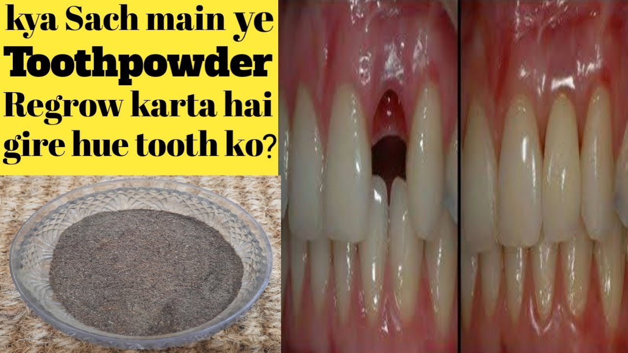 Ayurvedic Treatment for Dental Problems Cure for Pyria, Cavity, Gums ...