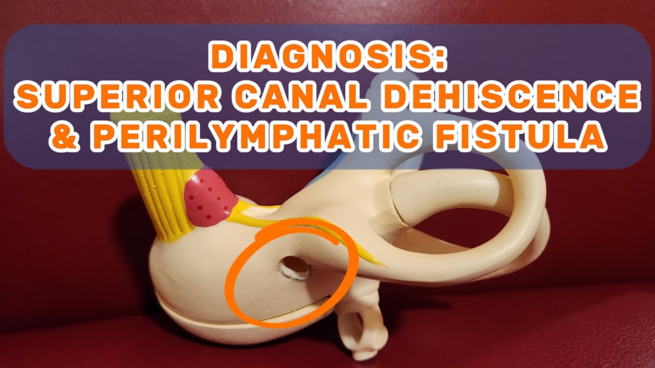 DIAGNOSIS: Superior Canal Dehiscence Syndrome & Perilymphatic Fistula ...