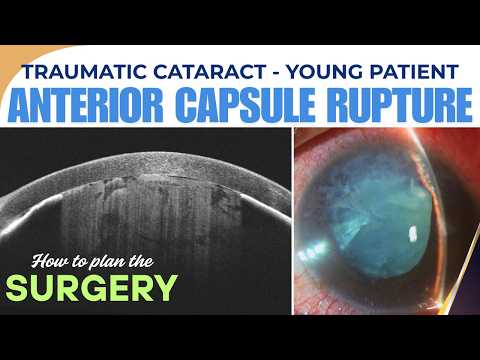 Traumatic cataract in a Young patient : How to plan the surgery - Dr. Deepak Megur