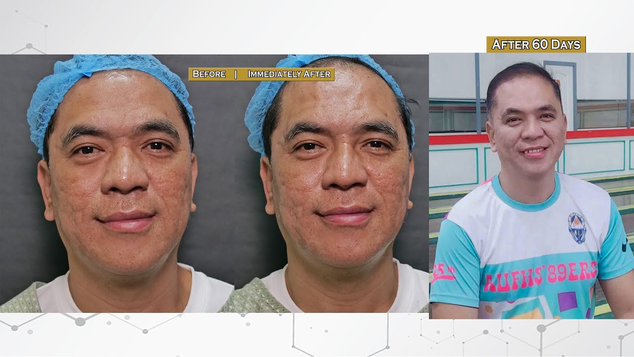 How to treat forehead deep wrinkles and volume loss, saggy jawline and ...