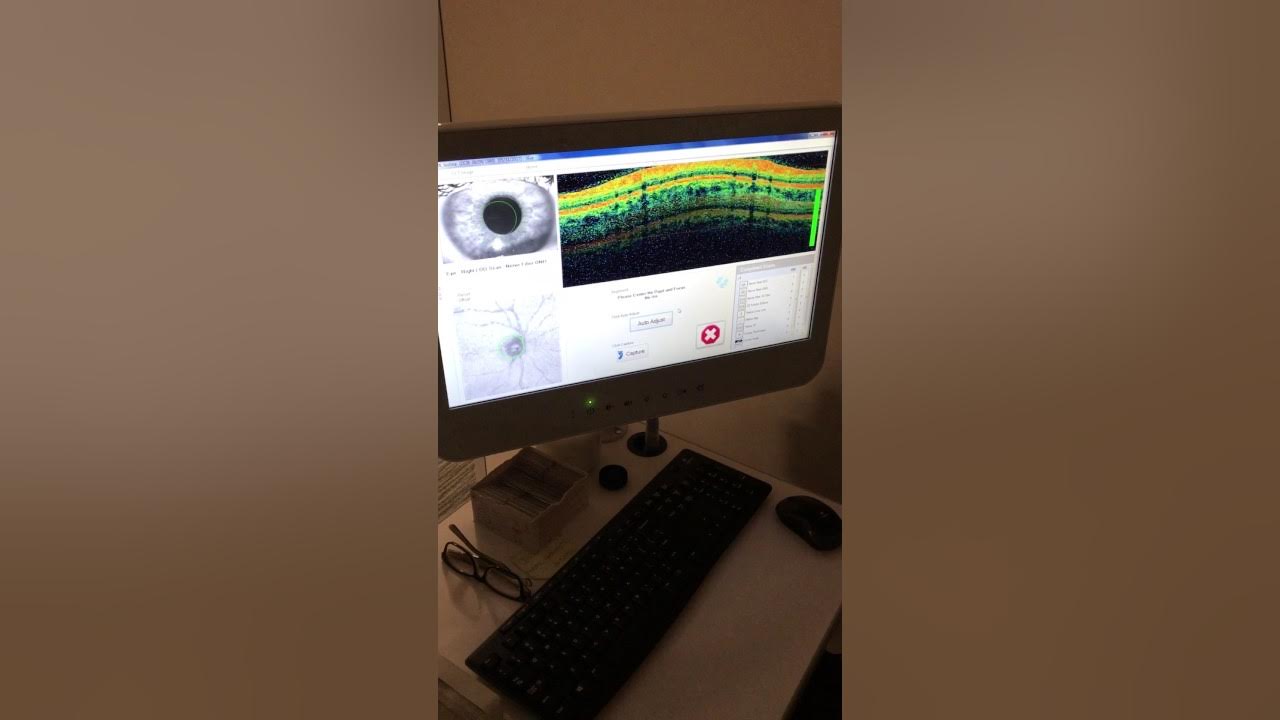 Optovue iVue 100 - YouTube