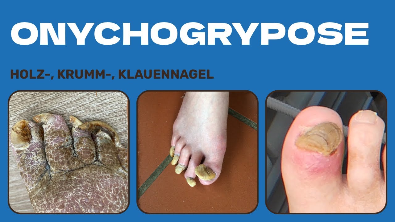 Onychogrypose: Eine tief gehende Analyse der Nageldeformität ...