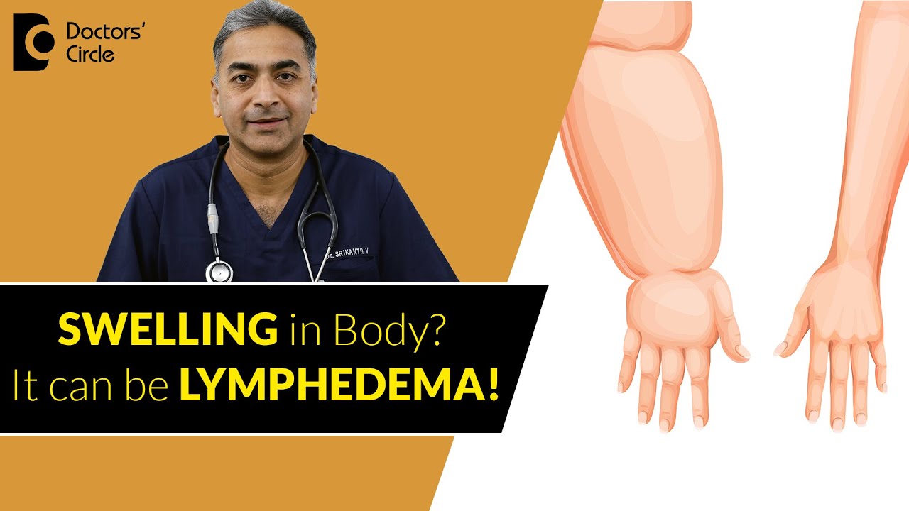 Swollen Limbs Treatment | Lymphedema Causes & Treatment - Dr. Srikanth ...