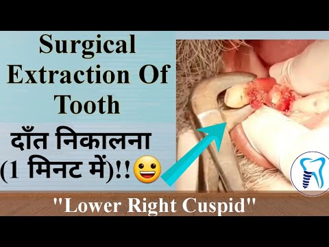Surgical Tooth Extraction- LR3 (Easy in 1 minute),By- Oral Surgeon ...