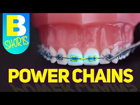 When Do You Get A Power Chain On Your Braces