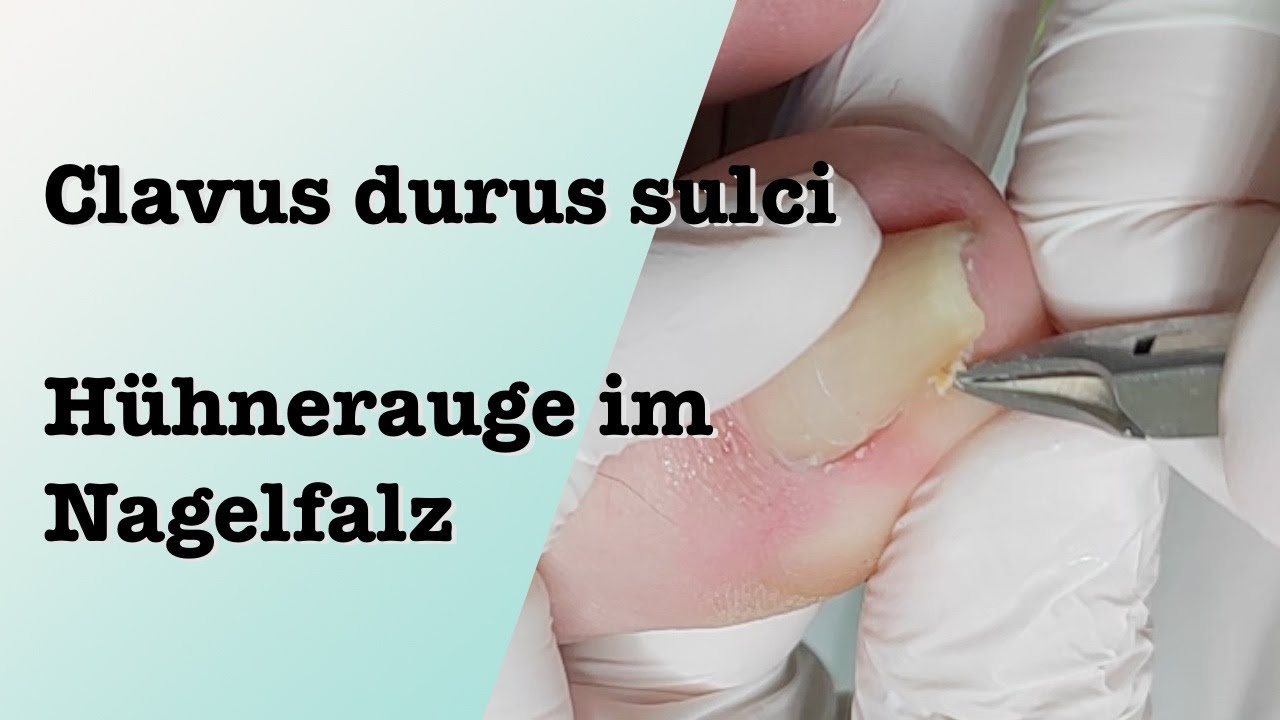 Clavus durus sulci, Hühnerauge im Nagelfalz entfernen, podologinandrea ...