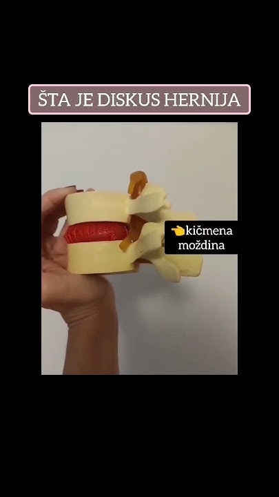 DISKUS HERNIJA #lumbalgia #terapeut #vezbezaledja #bol #lumbago # ...