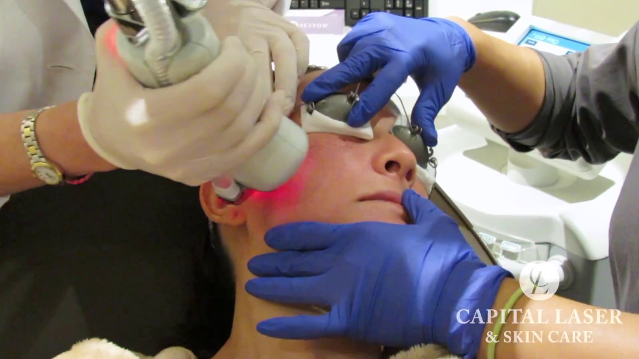 Halo Hybrid Fractional Laser Treatment with Dr. Elizabeth Tanzi - YouTube