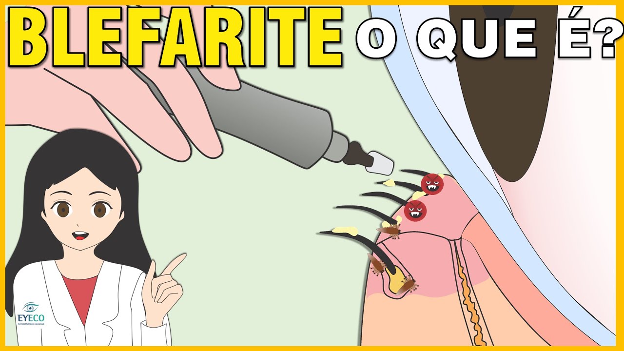 ASMR🎧 BLEFARITE: Diagnostico e Novos TRATAMENTOS! #Oftalmologia #saúde ...