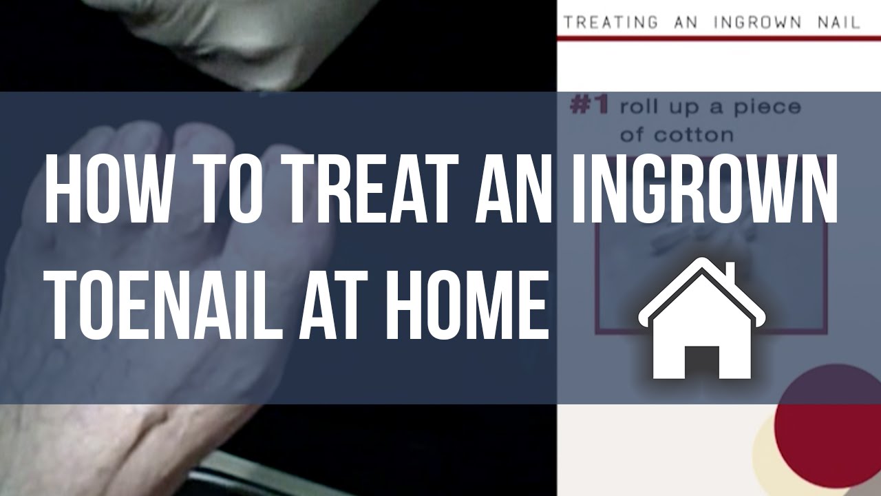 How to Fix an Ingrown Toenail at Home | Tutorial - YouTube