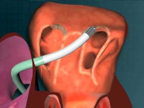 HCA Virginia - Hybrid Maze Procedure - YouTube