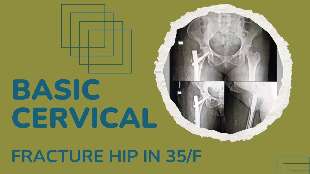 BASICERVICAL FRACTURE HIP IN 35/F DUE TO CHIROPRACTER MANIPULATION ...