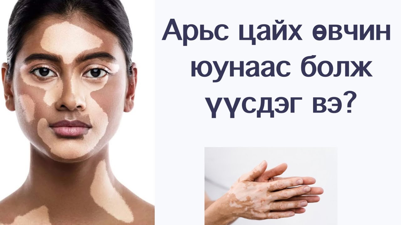 арьс цайх өвчин ямар хүмүүст их үүсдэг вэ Youtube