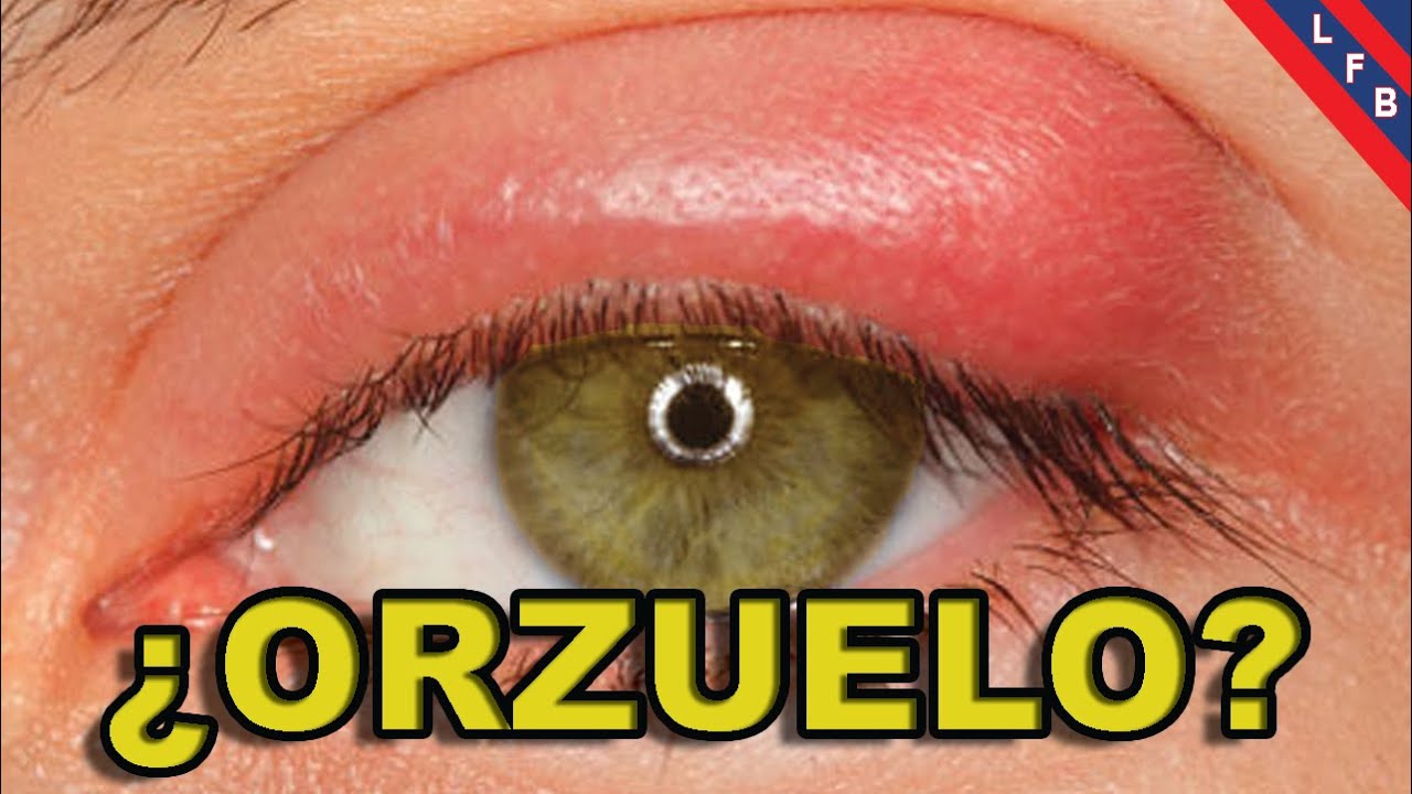 COMO QUITAR UN ORZUELO EN 5 PASOS - YouTube