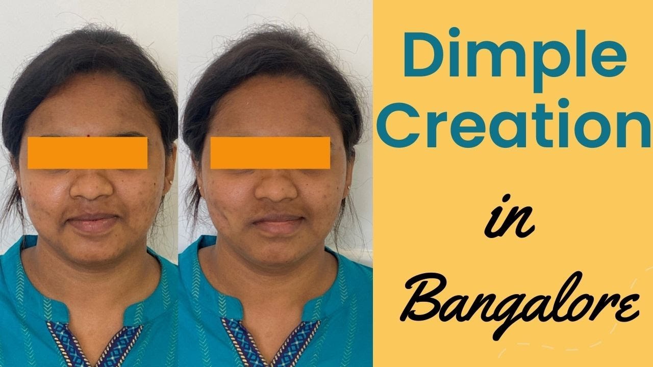 Dimple Creation in Bangalore- Get Dimples in 15mins! - YouTube